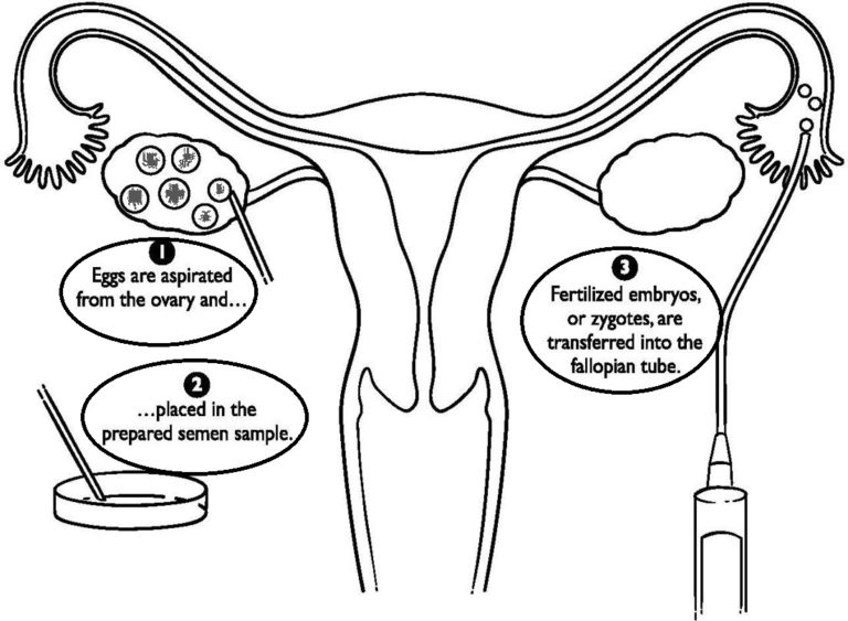 Gamete intrafallopian transfer(GIFT) - ARTbaby Georgia